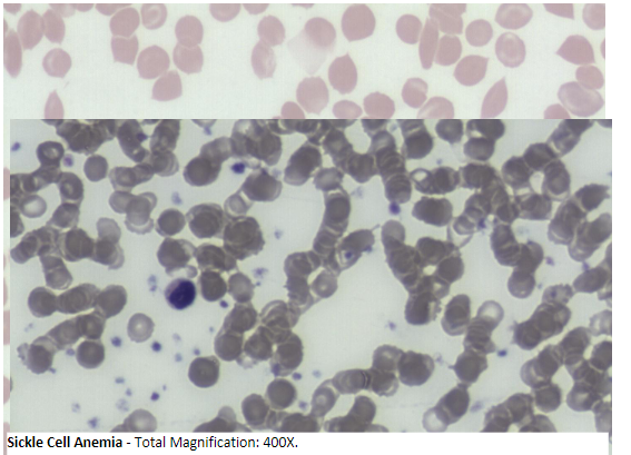 Solved Based on the slides of blood smears on the bottom, I | Chegg.com