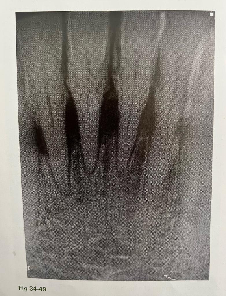 Identify the pattern of, severity of bone loss, and | Chegg.com