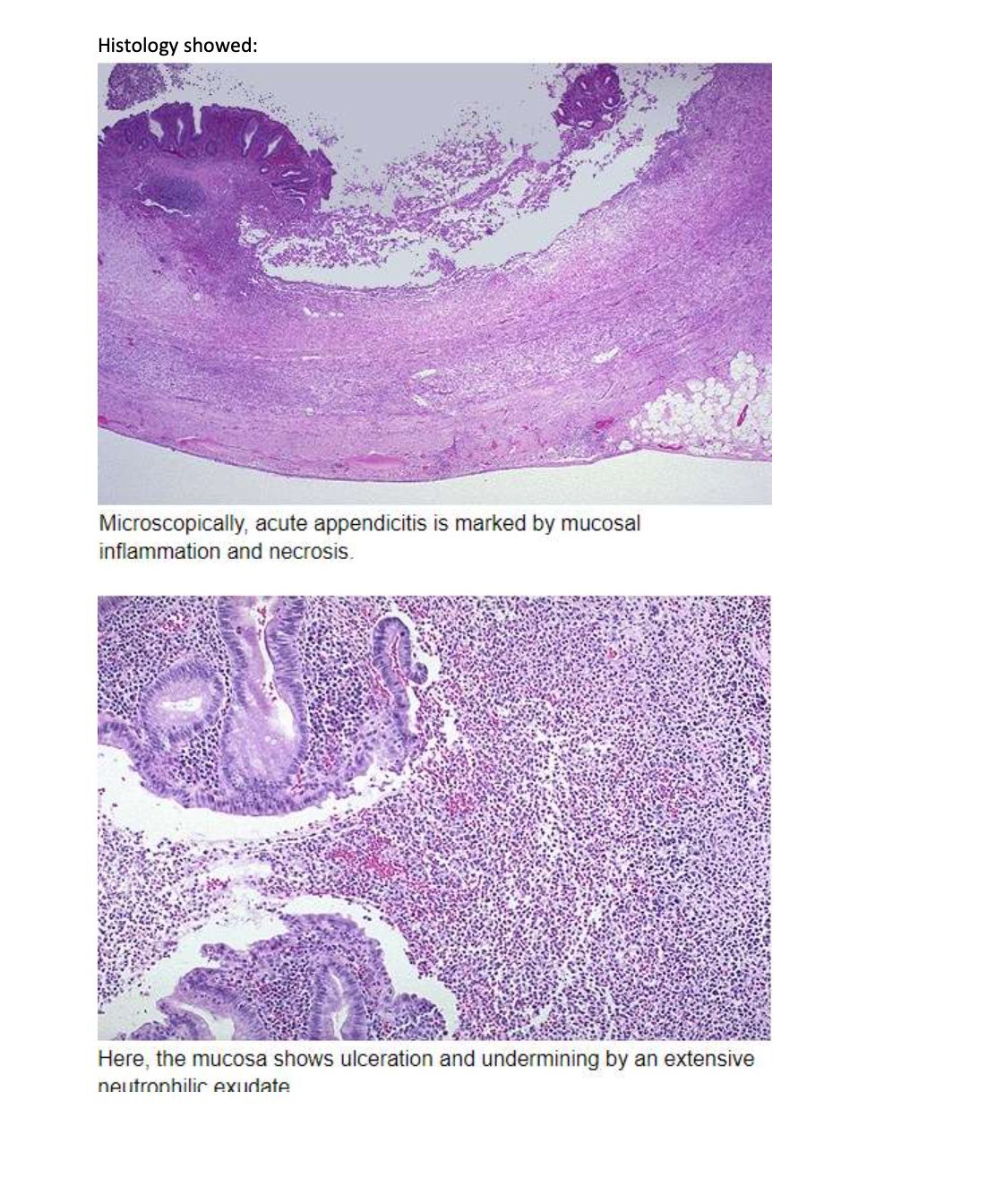Solved Histology showed: Microscopically, acute appendicitis | Chegg.com