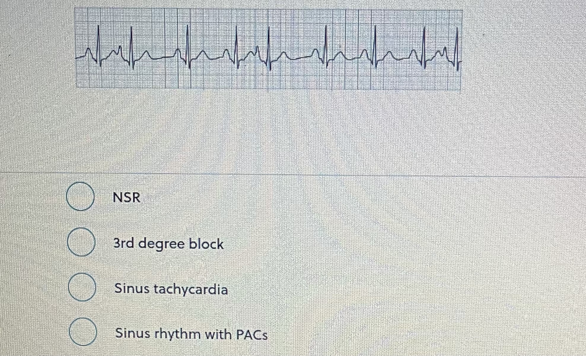 Solved NSR 3rd degree block Sinus tachycardia Sinus rhythm | Chegg.com