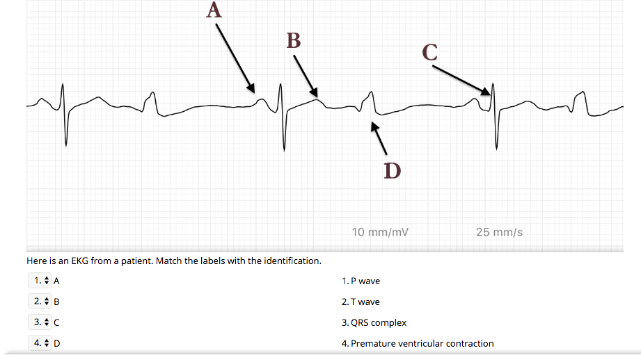 Solved Anatomy and Anatomy and Physiology II Question: EKG | Chegg.com