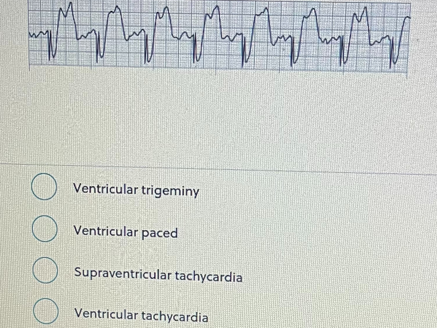 Solved Ventricular trigeminy Ventricular paced | Chegg.com