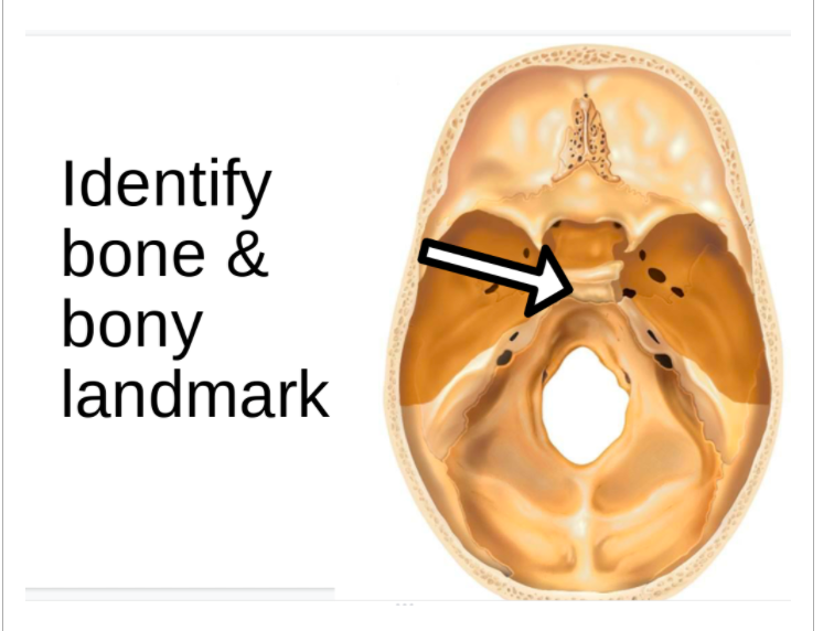 Solved Identify bone & bony landmark Identify bone & bony | Chegg.com