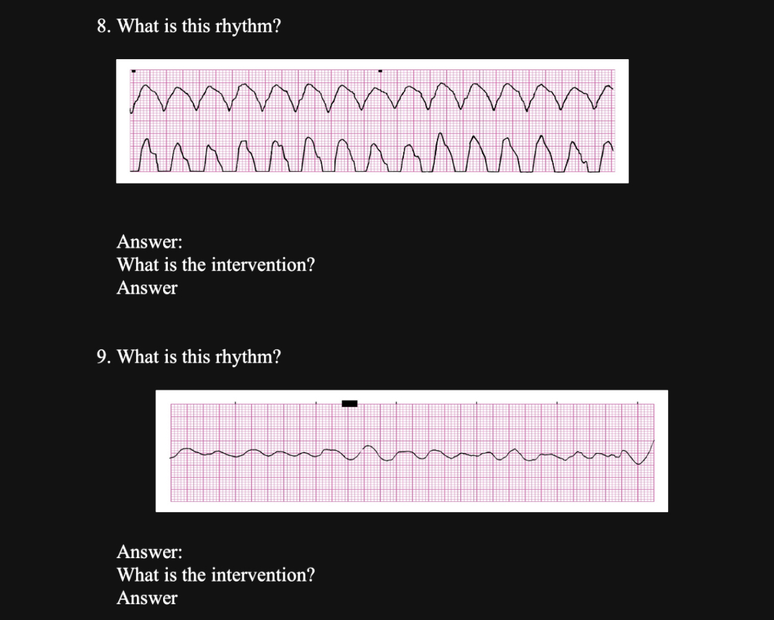 Solved What is this rhythm? Answer: What is the | Chegg.com