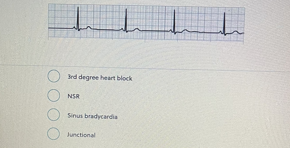Solved 3rd degree heart block NSR Sinus bradycardia | Chegg.com
