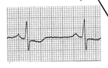 Solved For the following ECG, calculate the mean QRS vector. | Chegg.com