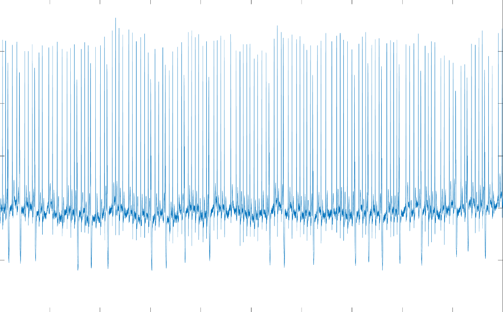 Find abnormalities in the following ECGs. In the | Chegg.com