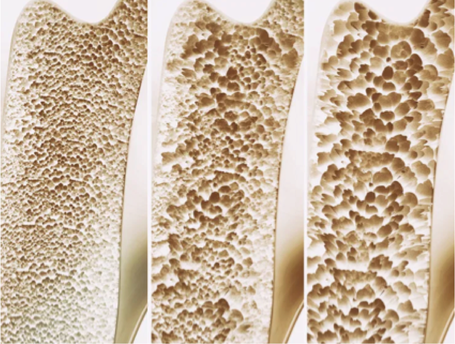 Solved Below are small bone samples taken from a vertebra of | Chegg.com