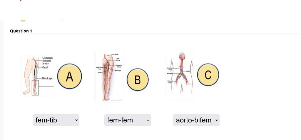 Question 1 Fem Tib Fem Fem Aorto Bifem ∨