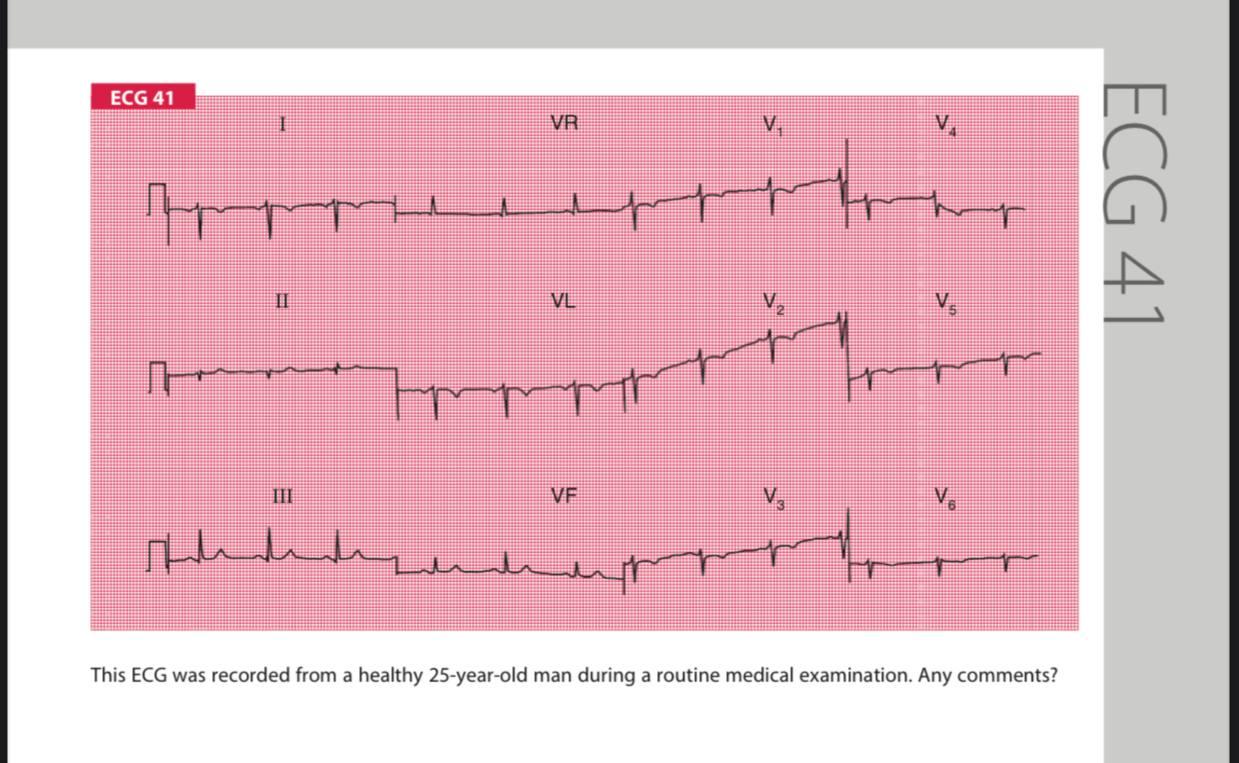 Solved ECG 41 1 VR V. v. Apment ECG 41 VL V, propres 111 VE | Chegg.com