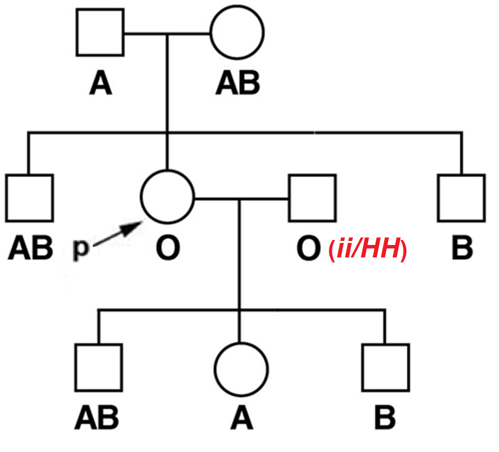 Solved Figure below shows a pedigree of a woman with the | Chegg.com
