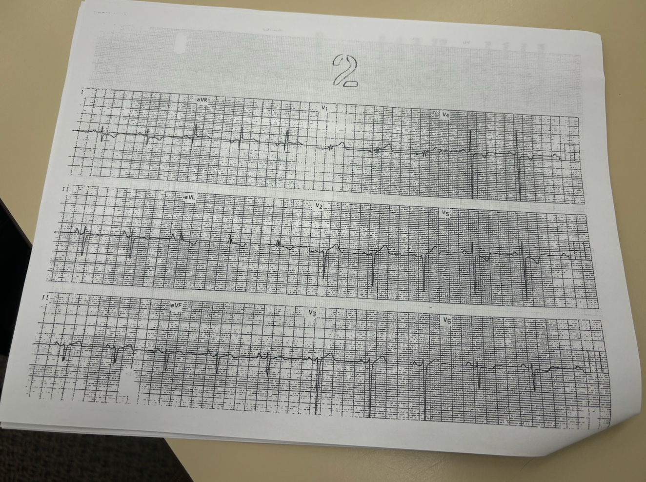 Solved Seen in ECG #2 ﻿is:a. ﻿evidence right ventricular | Chegg.com