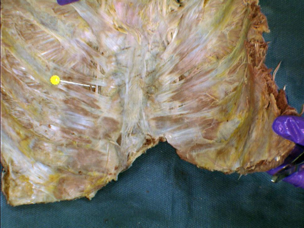 External Intercostals Cadaver