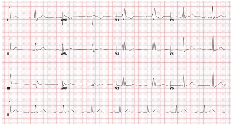 Solved what is occurring on this EKGLeft Bundle Branch | Chegg.com