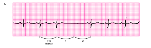 Solved Label the arrhythmia type on the EKG strip: (No | Chegg.com