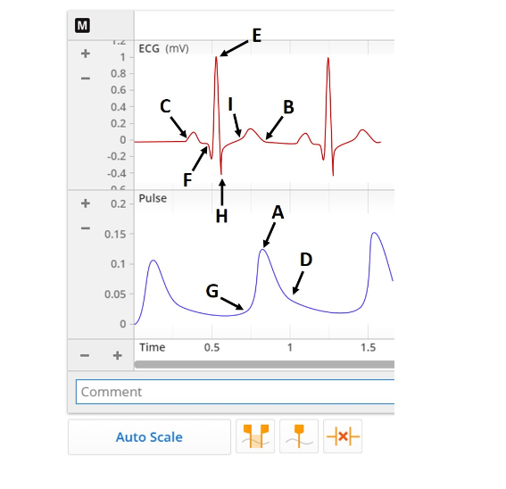 Solved In the figure above, to measure the QT interval, | Chegg.com