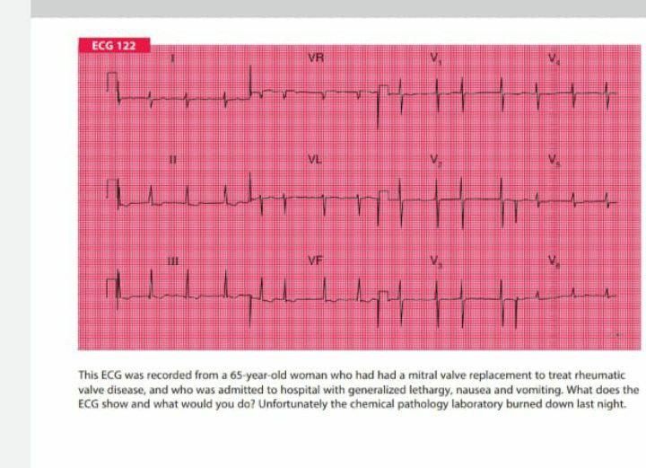 ECG 122 VR THHHH VE V V Luonto 111 MF V This ECG was | Chegg.com