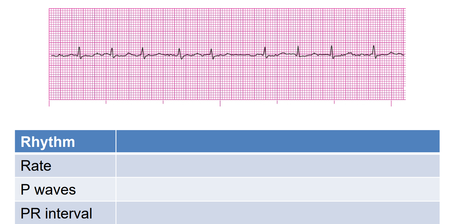 Solved How to interpret the ekg information on irregular | Chegg.com