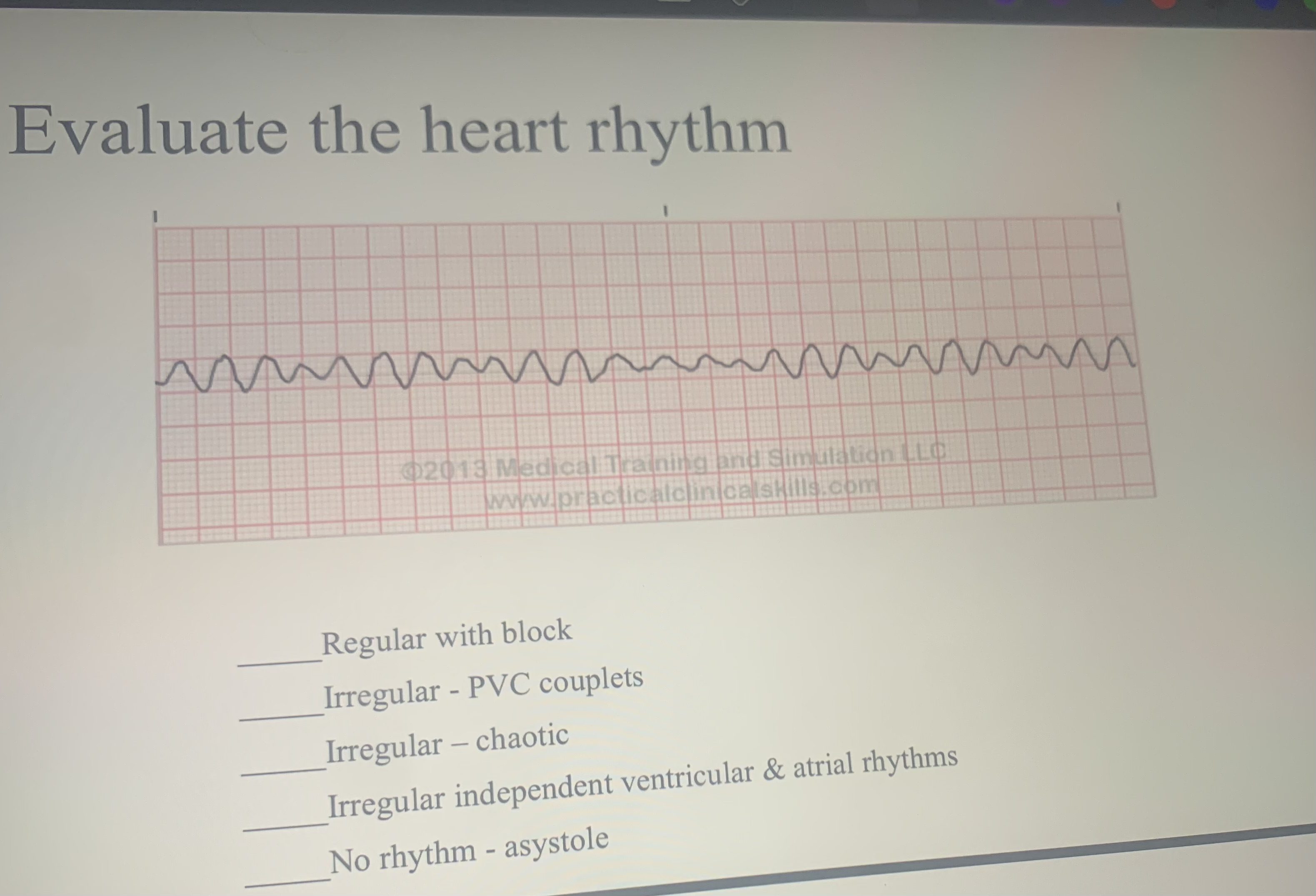 Solved Evaluate the heart rhythm Regular with block | Chegg.com