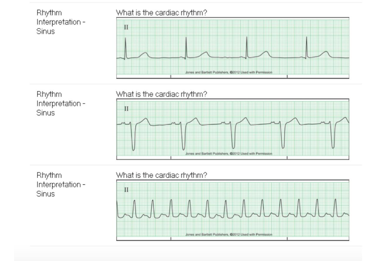 Solved Rhythm Interpretation - Sinus Rhythm Interpretation - | Chegg.com