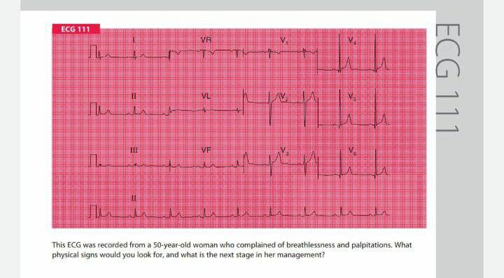 Solved ECG 111 V VE MIT ECG 111 VL M. I 111 VF W A This ECG | Chegg.com