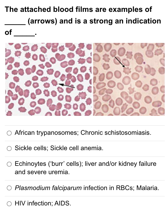 Solved The attached blood films are examples of (arrows) and | Chegg.com