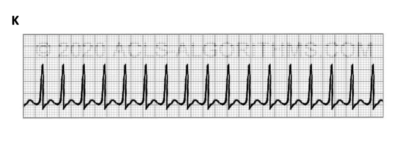 For each of the Lead II ECG traces of a resting heart | Chegg.com