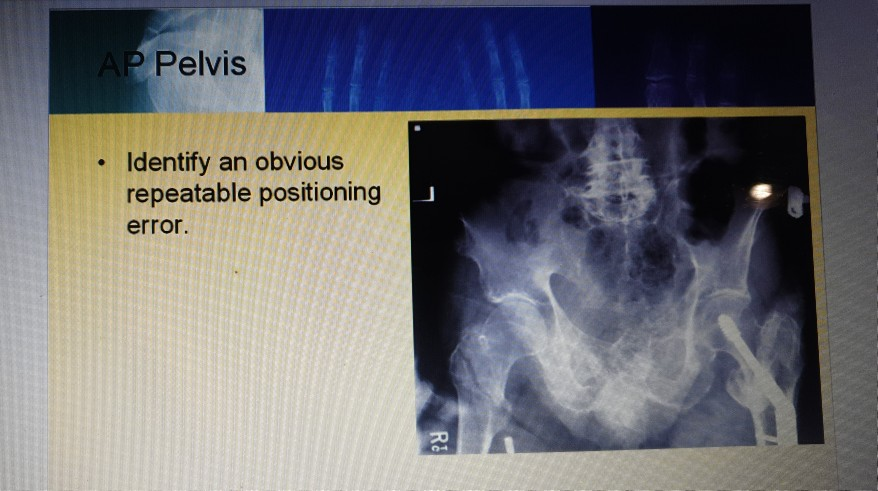 AP Pelvis Identify an obvious repeatable positioning | Chegg.com