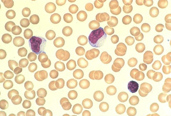 Solved Based on the blood smear above please grade RBC | Chegg.com