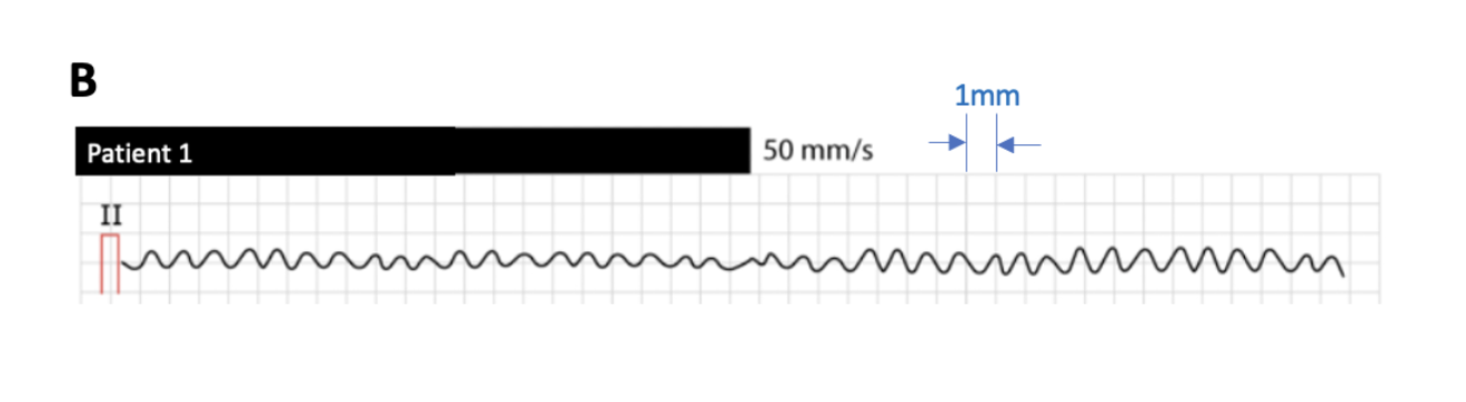 For each of the Lead II ECG traces of a resting heart | Chegg.com