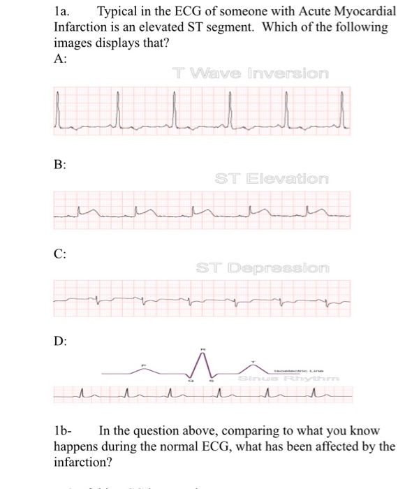 Solved la. Typical in the ECG of someone with Acute | Chegg.com