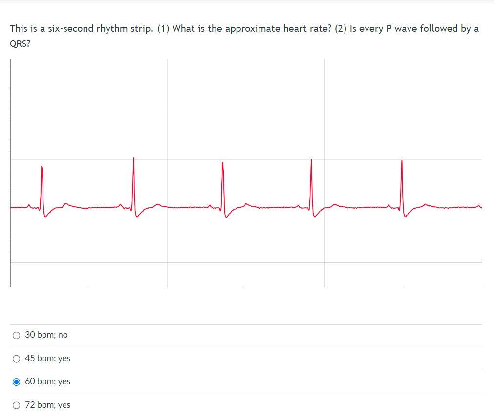 Solved This is a six-second rhythm strip. (1) What is the | Chegg.com