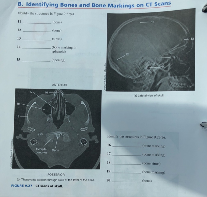 Solved A. Identifying Bones and Bone Markings on Radiographs | Chegg.com