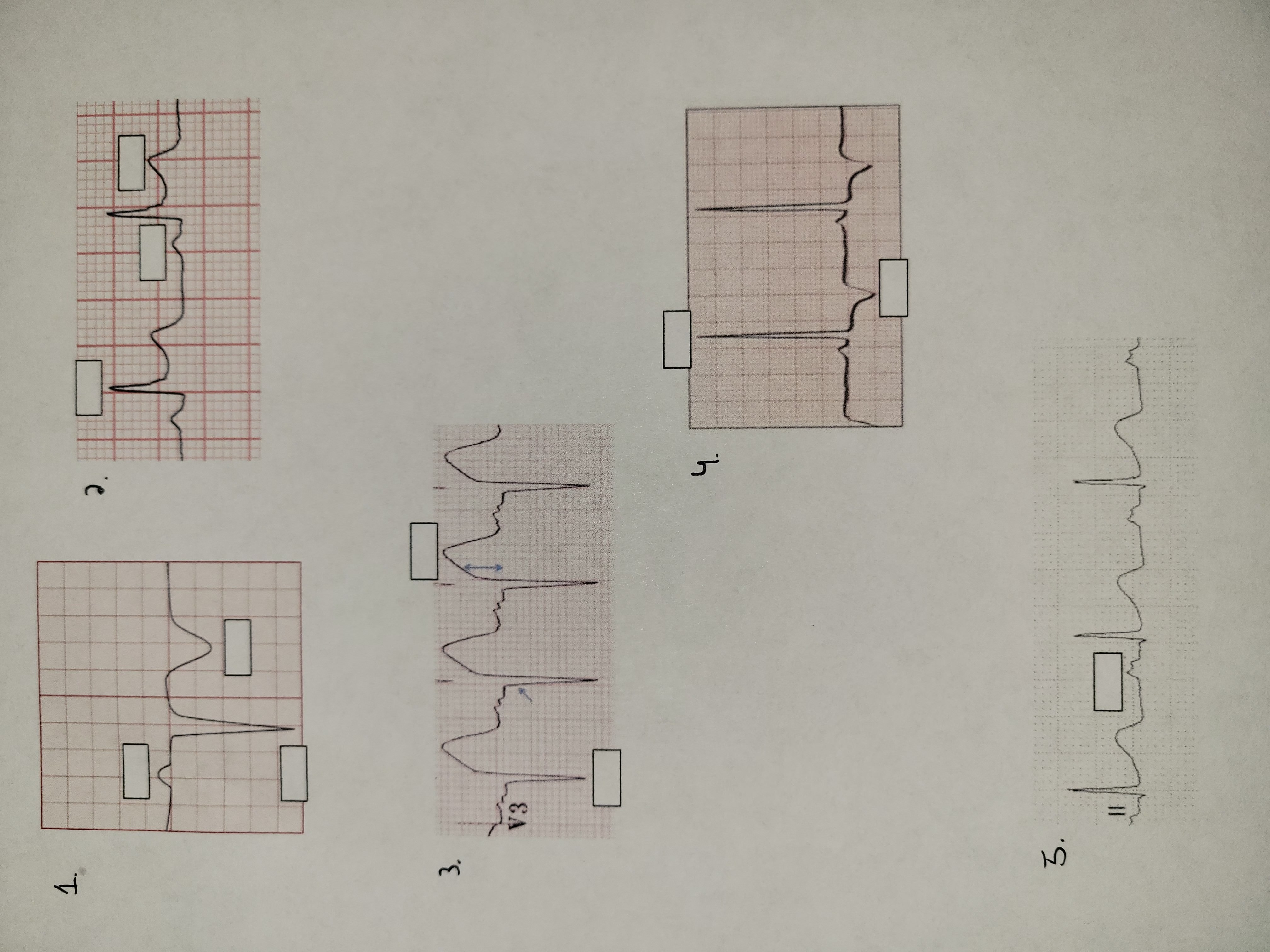 Solved Identify the P,Q,R,S,T waves for each text box near | Chegg.com