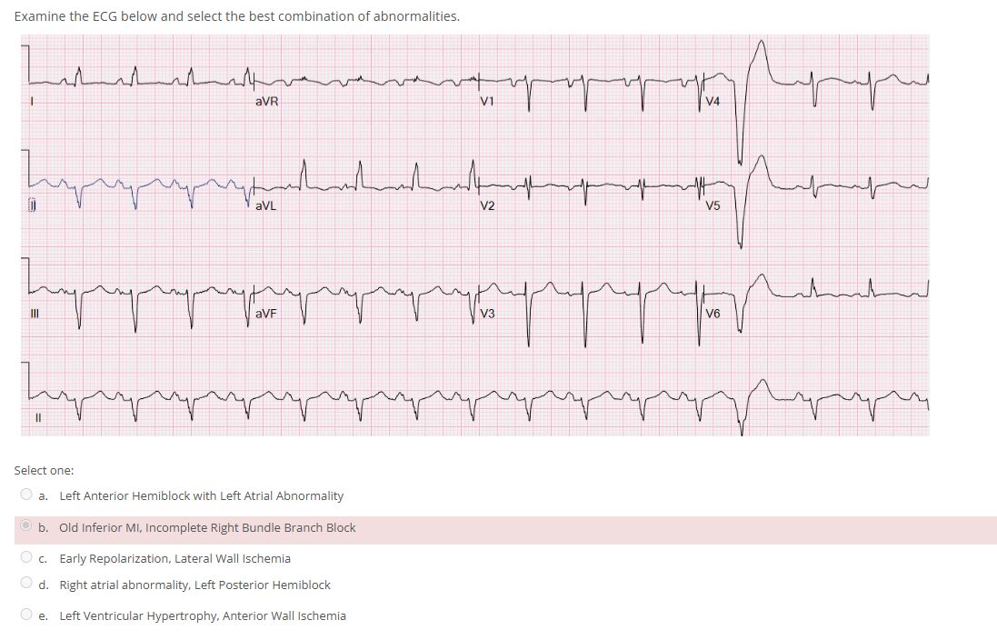 Solved Examine the ECG below and select the best combination | Chegg.com