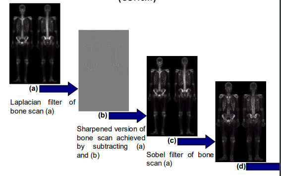 (a) Laplacian filter of bone scan (a) (b) Sharpened | Chegg.com