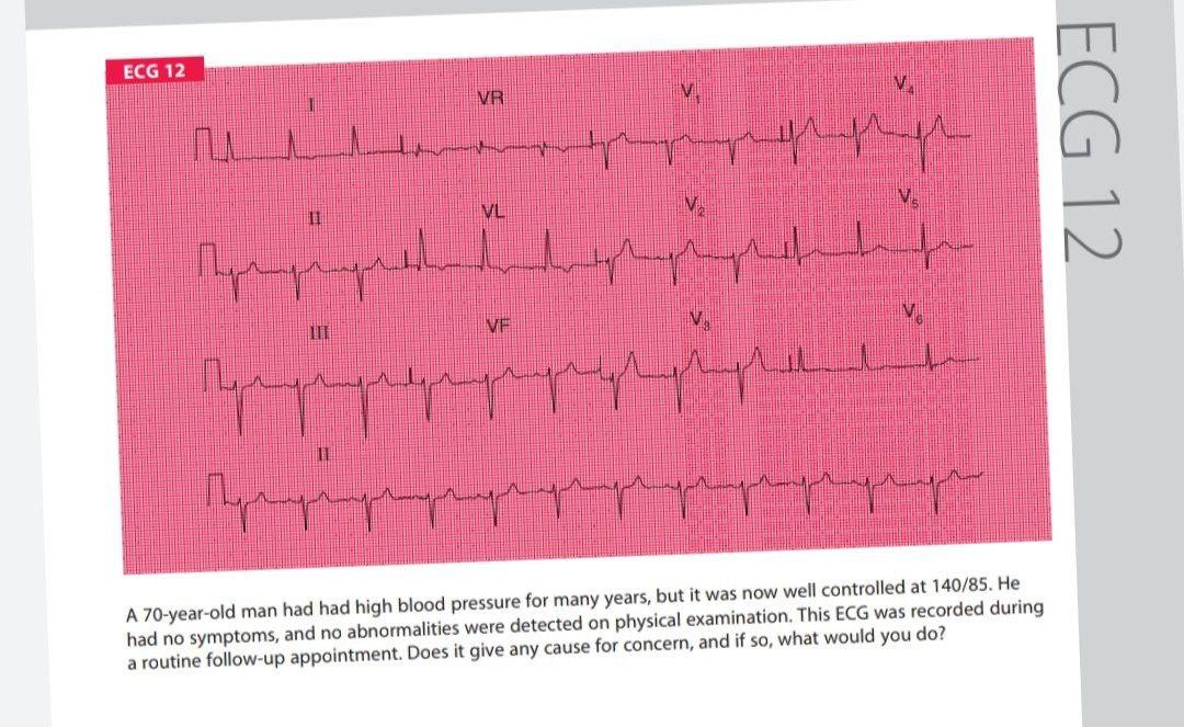 Solved ECG 12 V VR ECG 12 11 VL yapmaquil VE II Typray ry A | Chegg.com