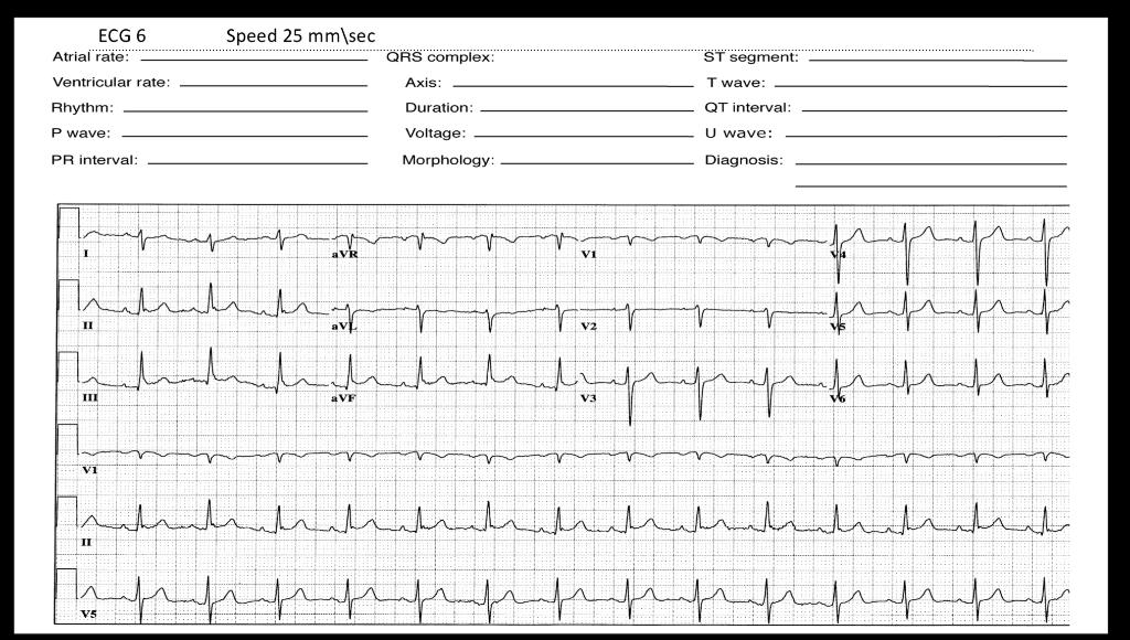 ECG 1 Speed 25 mm\sec QRS complex: Atrial rate: | Chegg.com