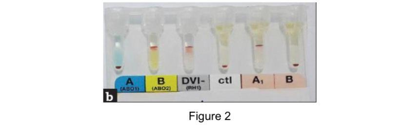 Solved Figure 2 below shows the gel card blood group typing | Chegg.com