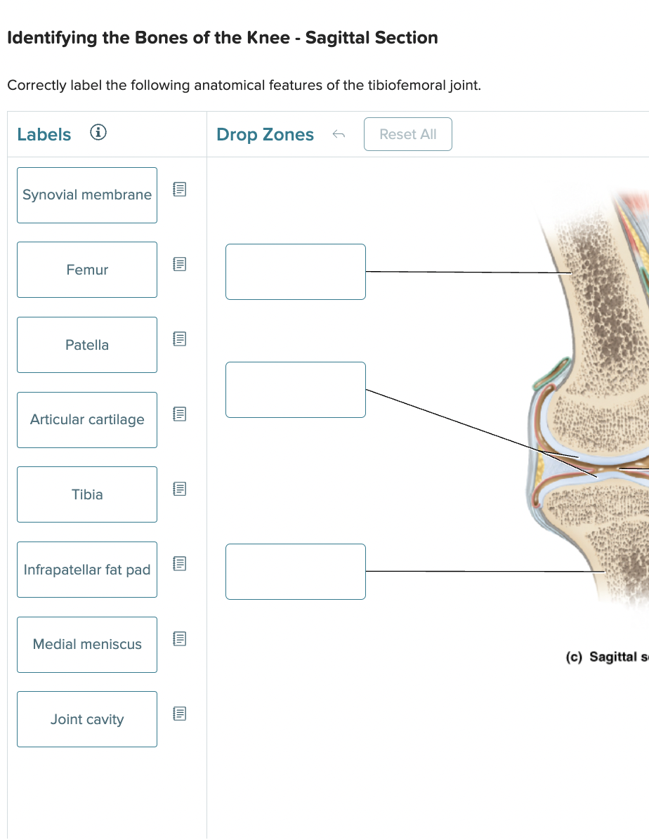 Solved Identifying the Bones of the Knee - ﻿Sagittal | Chegg.com