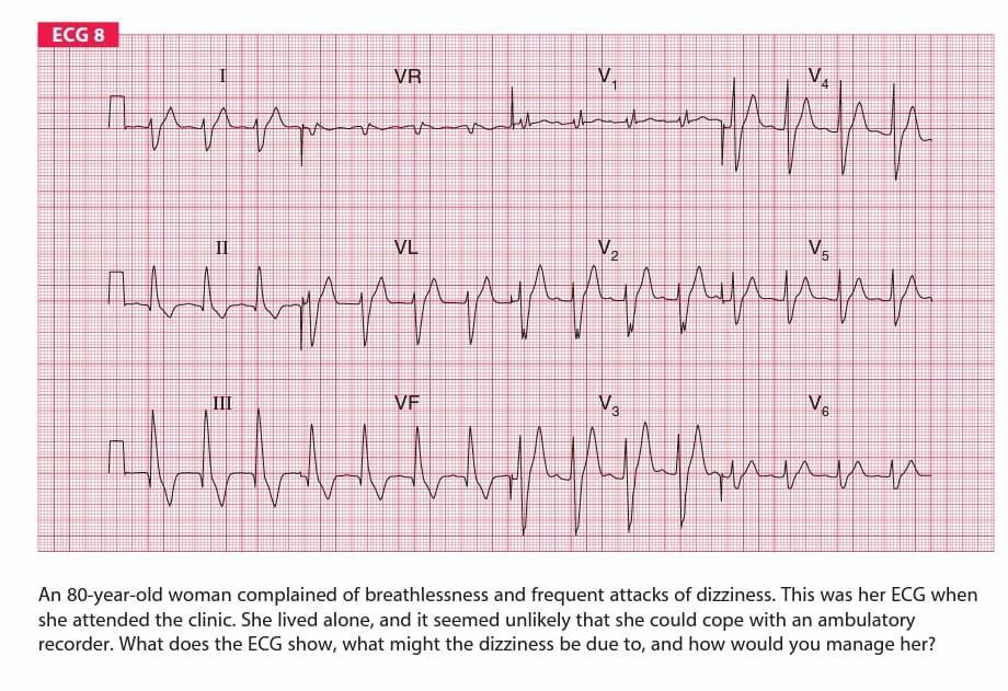 Solved ECG 8 VR у. V. Палант M да - s S. - $ П VL V, VA with | Chegg.com