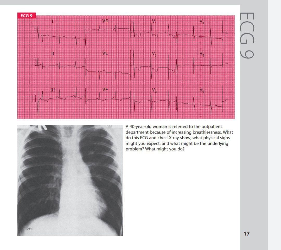 Solved ECG 9 VR V v TT ECG 9 II VE V hu th AND VE V V. na "L | Chegg.com