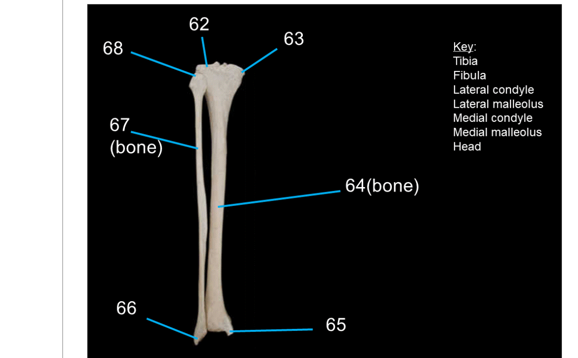 Solved 62 63 68 Key Tibia Fibula Lateral condyle Lateral | Chegg.com