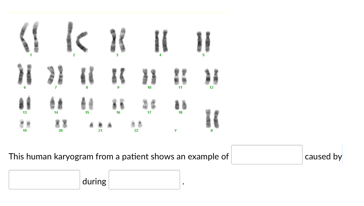 Solved This human karyogram from a patient shows an example | Chegg.com