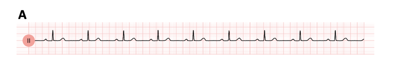 For each of the Lead II ECG traces of a resting heart | Chegg.com