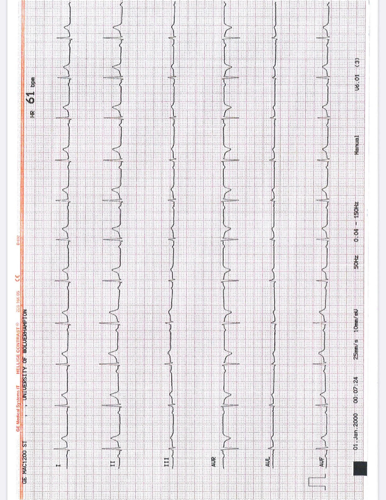 Solved ¬¬¬From the ECG trace (attached) calculate the | Chegg.com