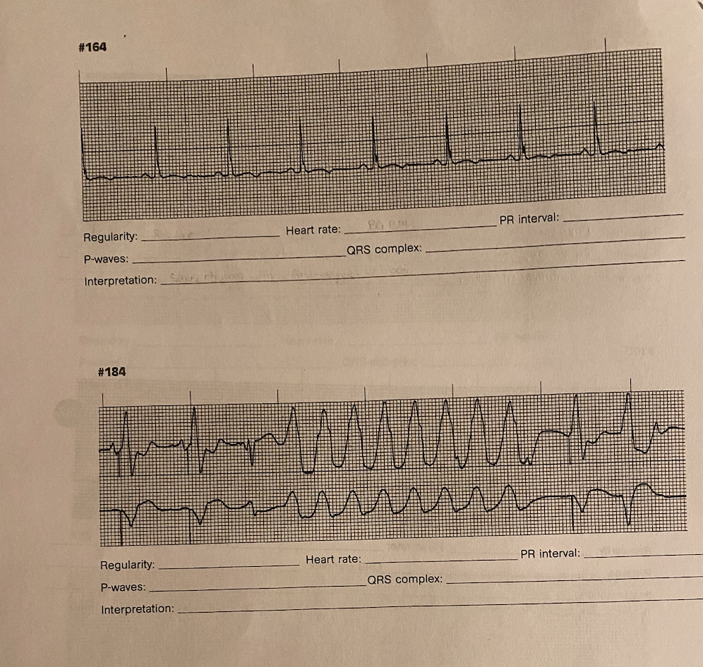 Solved Regularity: Heart rate: PR interval: P-waves: QRS | Chegg.com