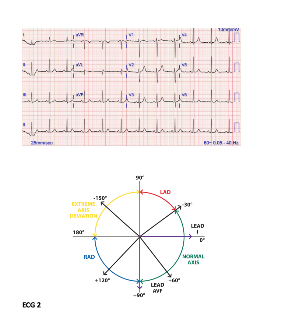 Solved Determine the Mean Electrical Axis represented by the | Chegg.com