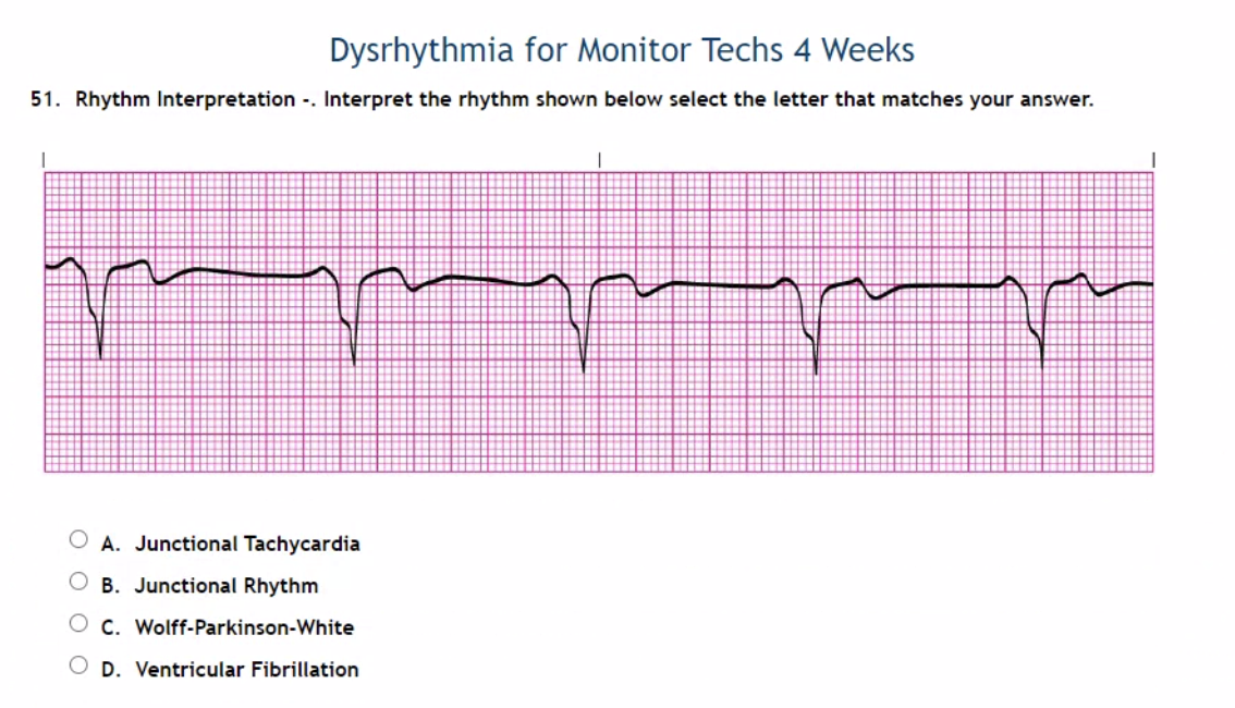 Solved Dysrhythmia for Monitor Techs 4 Weeks 51. Rhythm | Chegg.com