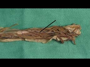 Solved This structure is the filum terminale. What is it | Chegg.com